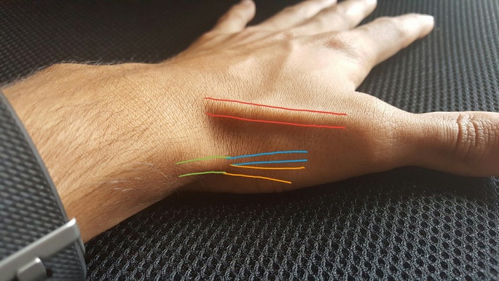 Abductor Pollicis Longus Dolor: signos, síntomas, causas, tratamiento