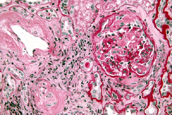 Amiloidosis renal: causas, factores de riesgo, clasificación, síntomas ...