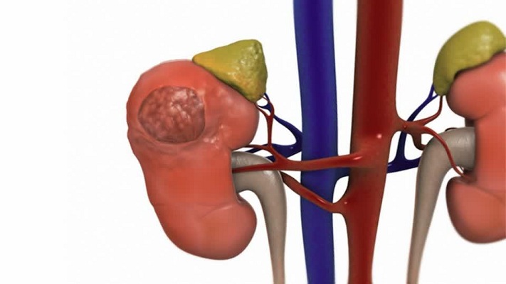 Cáncer Ureteral o Cáncer de Ureter o Cáncer de Pelvis Renal: Causas ...