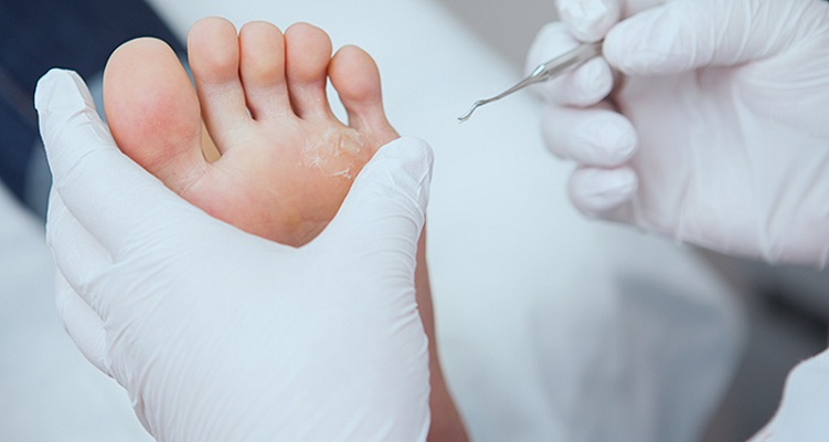 Callos y callosidades: tratamiento y remedios caseros