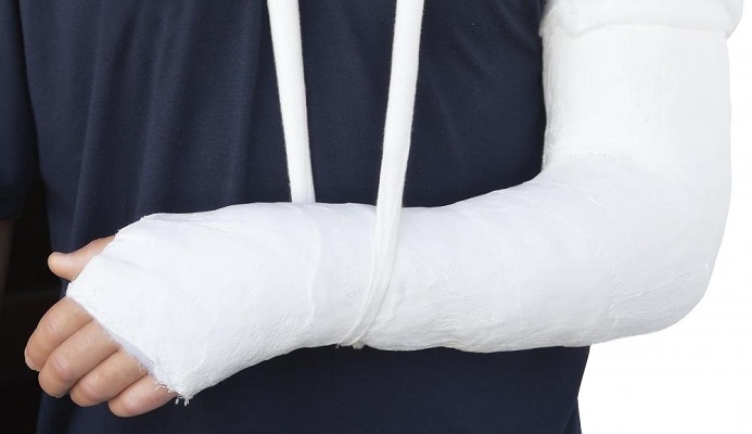 Codo fracturado: causas, síntomas, tratamiento, recuperación, terapia ...