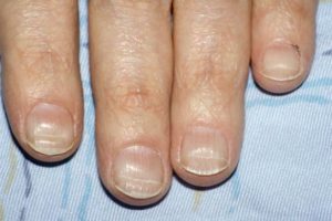 Notalgia Parestésica: Tratamiento, Ejercicios, Causas, Síntomas ...