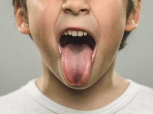 Lengua morada: causas, síntomas, tratamiento