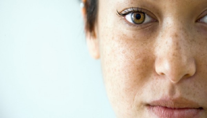 ¿Qué es la ocronosis y cómo se trata?