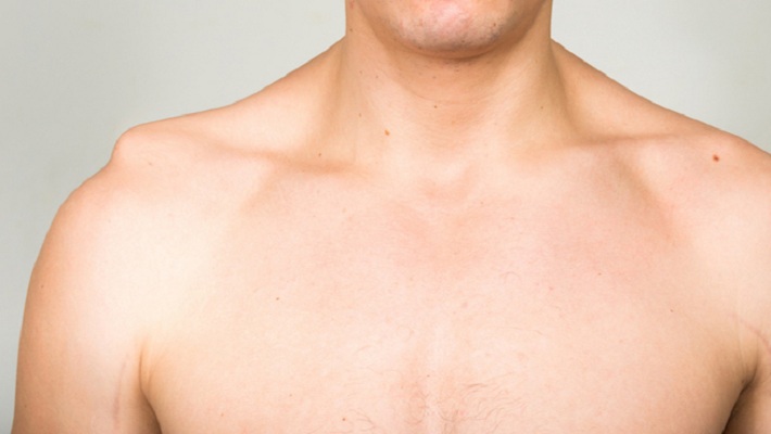 Separación del hombro o separación de la articulación acromioclavicular ...