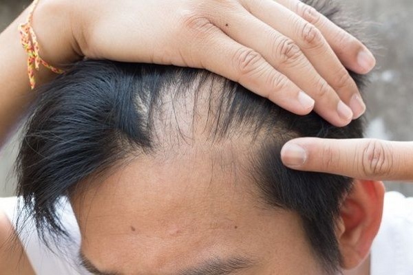 Efluvio telógeno: causas, tratamiento, cuánto tiempo dura, remedios ...