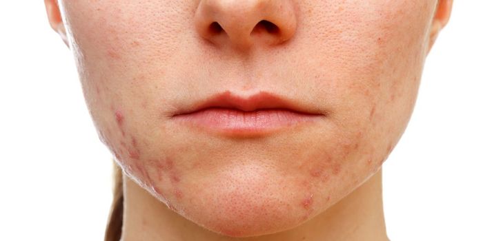 Acerca del acné vulgar y remedios caseros para deshacerse de él?