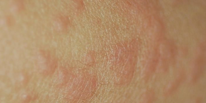 Acrodermatitis o síndrome de Gianotti-Crosti: causas, signos, síntomas ...