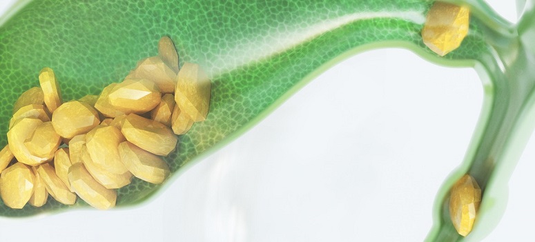 Colelitiasis: clasificación y tipos, causas, factores de riesgo, signos ...