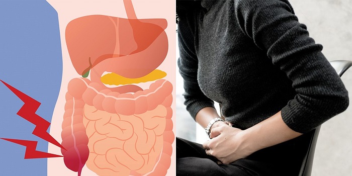 ¿De qué lado está el Apéndice y qué lo causa a estallar?