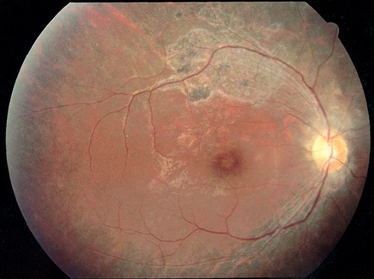 Commotio Retinae: síntomas, tratamiento, fisiopatología, recuperación ...