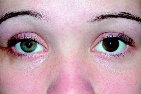 Midriasis: causas, síntomas, tratamiento, diagnóstico, prevención