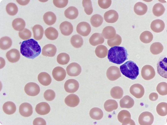 Mielofibrosis: causas, síntomas, tratamiento, expectativa de vida ...