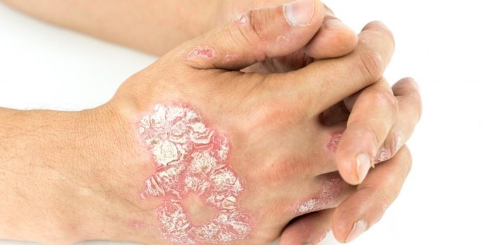 ¿Qué es la Psoriasis en placa y cómo se trata?