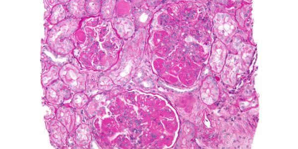 ¿Qué es la nefritis lúpica y cómo se trata?