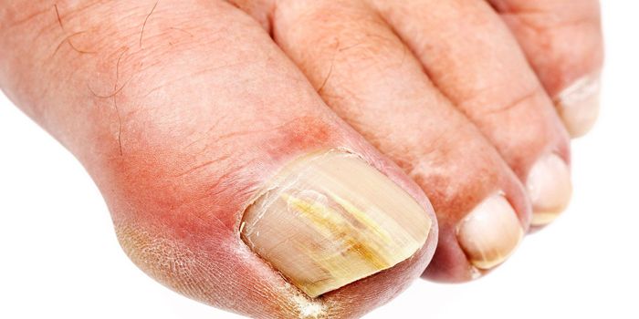 ¿Qué es un lecho ungueal, causas y tratamientos del lecho ungueal dañado?