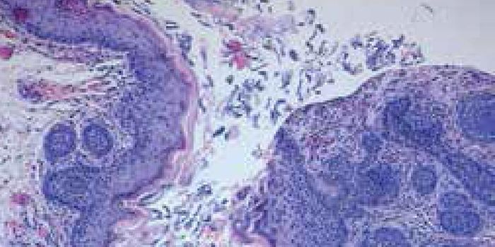 ¿Qué es un tumor folicular capilar o un foliculoma? Causas, síntomas ...