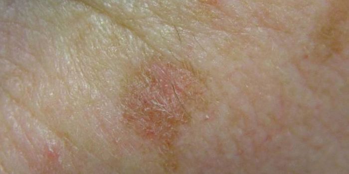 Queratosis Actínica o Queratosis Solar: Causas, Síntomas, Tratamiento ...