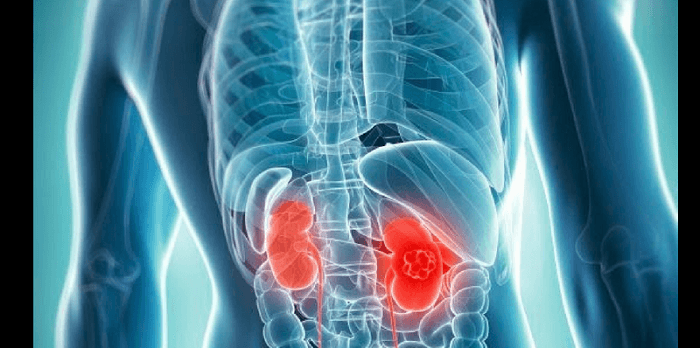 Carcinoma de células renales (cáncer de riñón) | Causas | Factores de ...