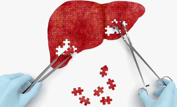 Daño hepático o insuficiencia hepática: causas, signos, síntomas ...