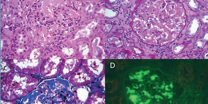 Nefropatía C1q: causas, síntomas, diagnóstico, tratamiento del manejo ...