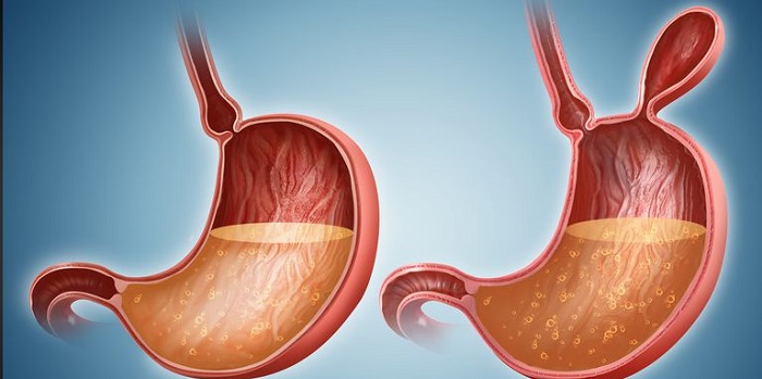 Obstrucción intestinal u obstrucción intestinal: causas, factores de ...