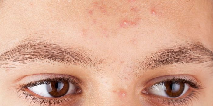 ¿Qué causa una pústula?