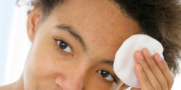 ¿Qué es el acné leve y qué hacer al respecto?