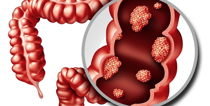 ¿Qué es la poliposis adenomatosa familiar y cómo se trata?