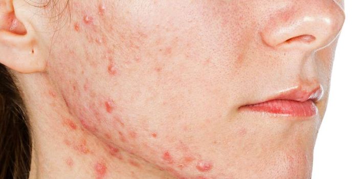 ¿Qué se considera como un acné grave y cuáles son sus causas?