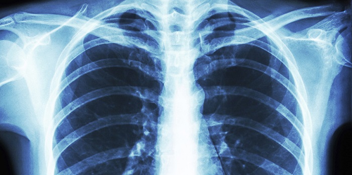 Síndrome de Chilaiditi: Causas, Síntomas, Tratamiento, Prevención ...