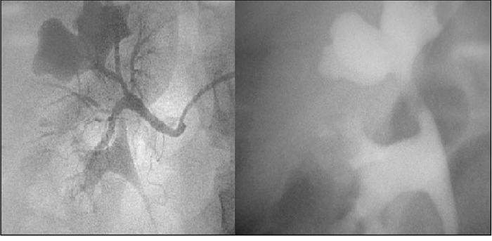 Síndrome de Fraley: tratamiento, causas, síntomas, diagnóstico