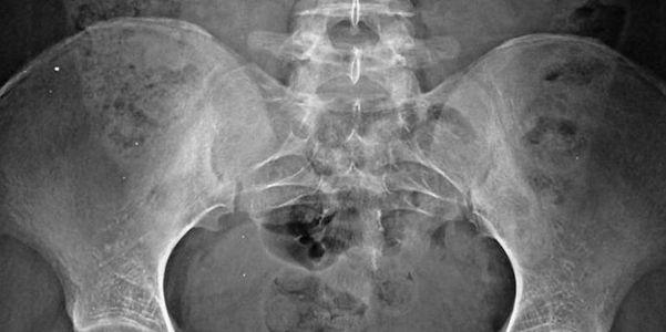 Nefrocalcinosis medular: causas, síntomas, tratamiento