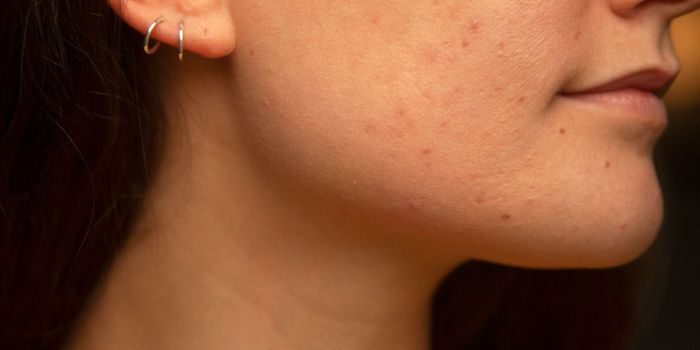 ¿Qué es un nódulo de acné?