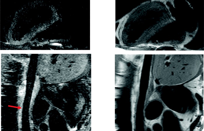 Aortitis: Síntomas, Causas, Tratamientos, Complicaciones
