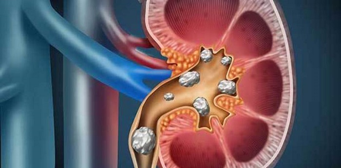 ¿Qué pasaría si las piedras en el riñón no se tratan?